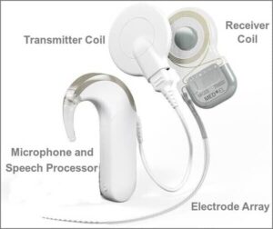 Frequently asked questions about cochlear implants