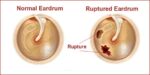 Ruptured Eardrum causes, symptoms and treatment